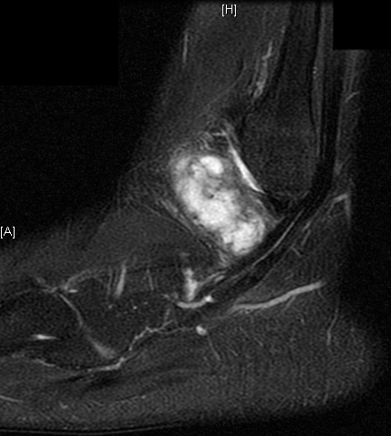 Synovial Sarcoma