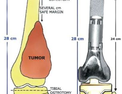 Distal Femur Tumor Prosthesis Replacement